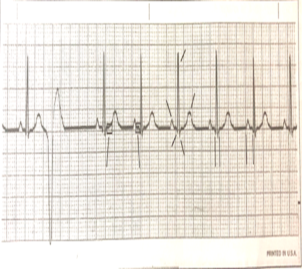 Solved Label on the sample EKG:All Waves (P, Q, R, S, | Chegg.com