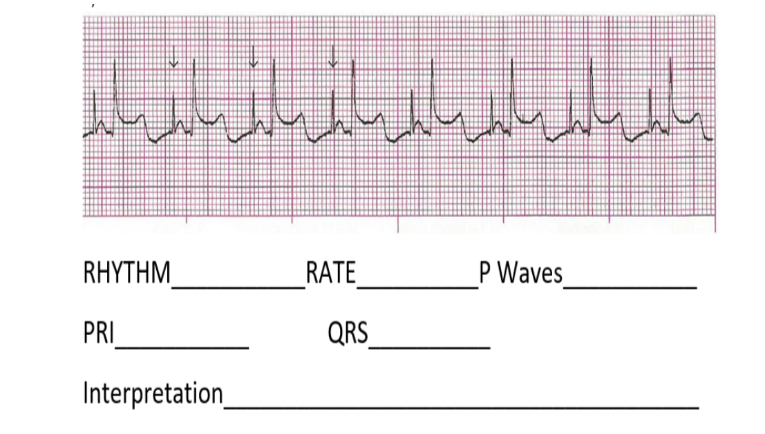 Solved Need help with this rhythm strip. Rhythm____ | Chegg.com