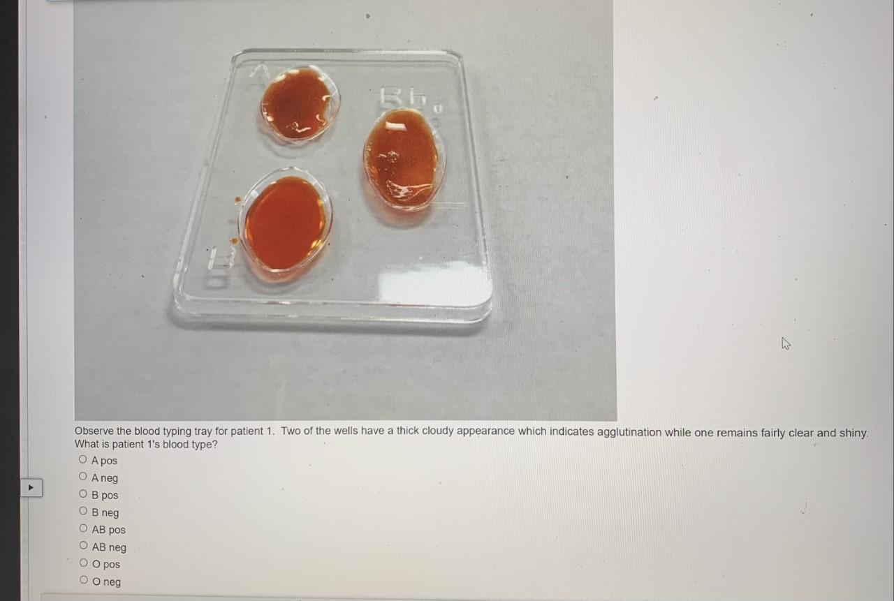 Solved Bha Observe the blood typing tray for patient 1. Two | Chegg.com