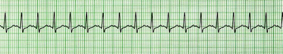 What is the rate, rhythm, PRI, QRSI and | Chegg.com