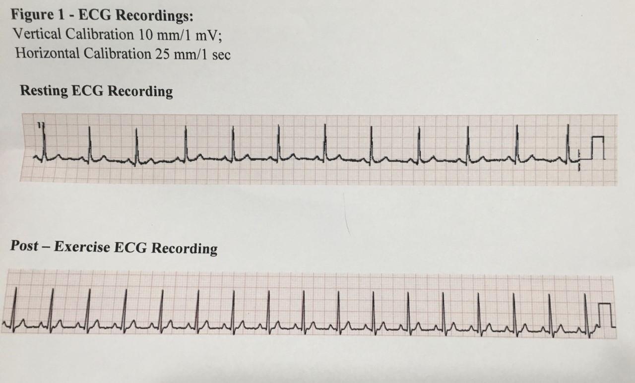 Solved Figure 1 - ECG Recordings: Vertical Calibration 10 | Chegg.com