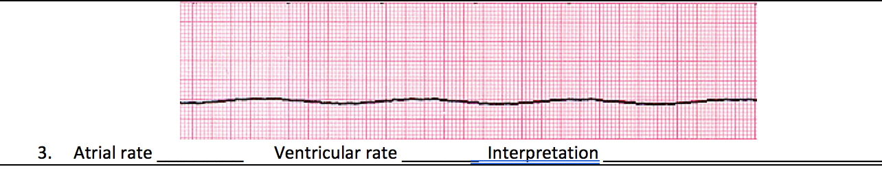 Solved 3. Atrial rate Ventricular rate Interpretation | Chegg.com