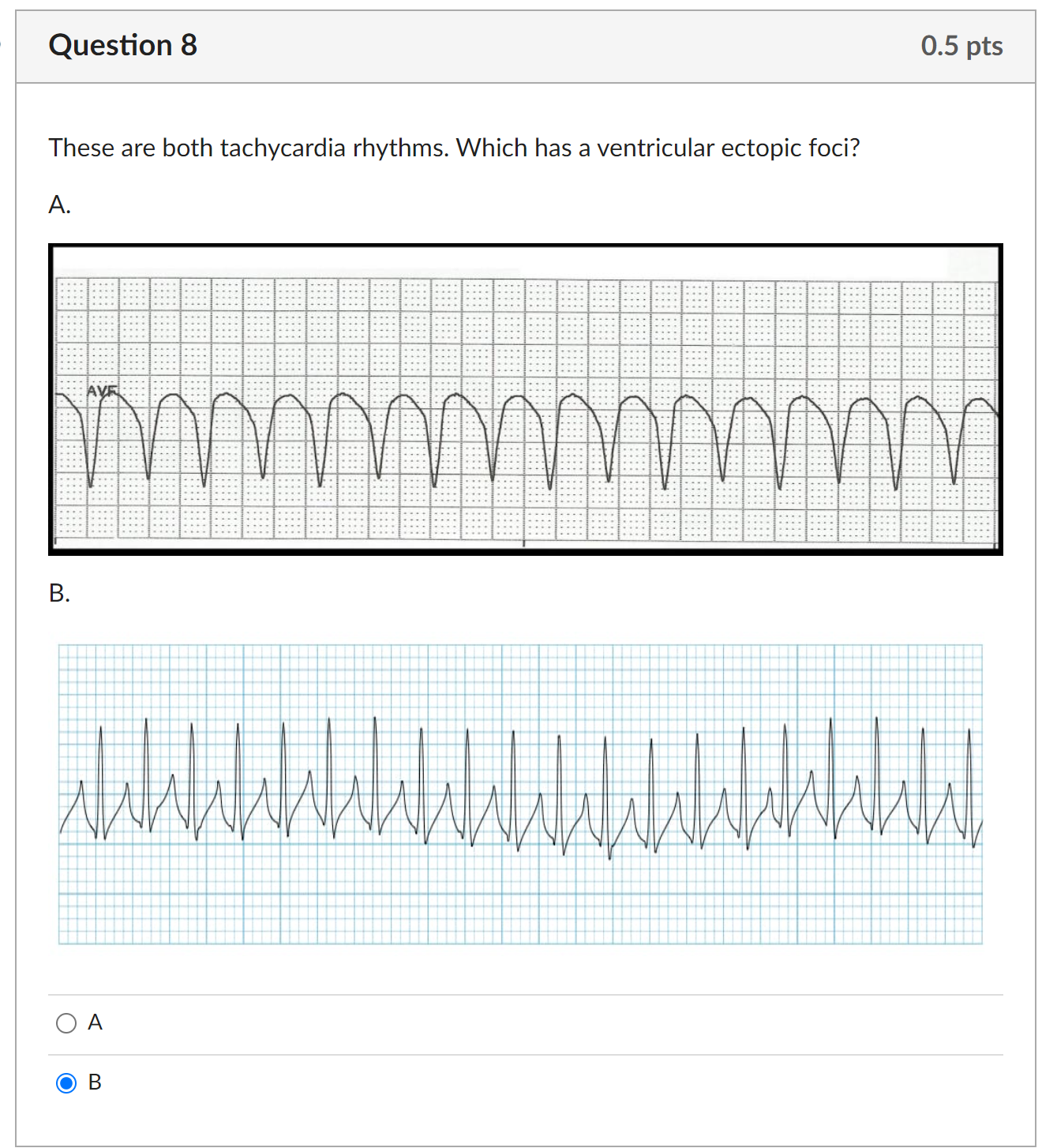 Solved Which ventricular tachycardia has a single | Chegg.com
