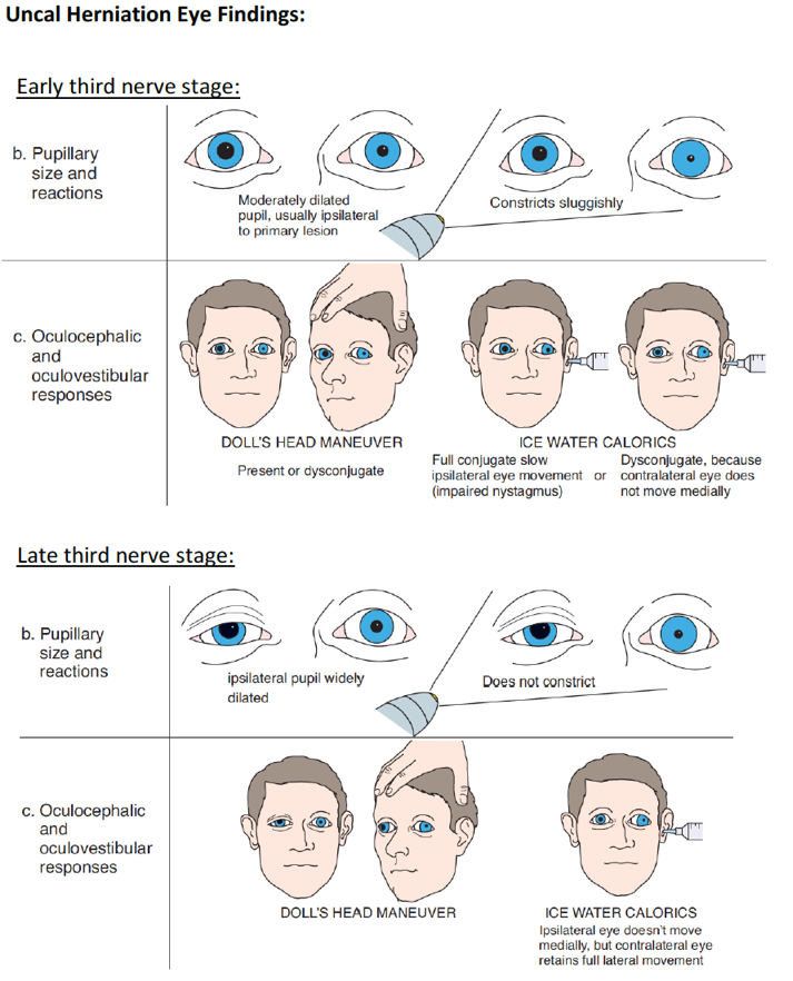 Uncal Herniation Eye