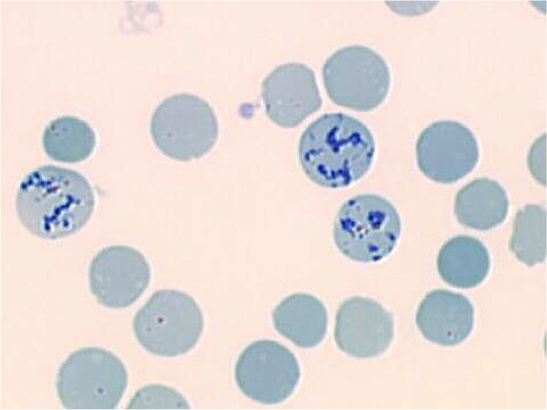 Reticulocyte Supravital Stain
