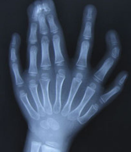 Solved Below is an X-ray image of someone with “mirror hand” | Chegg.com