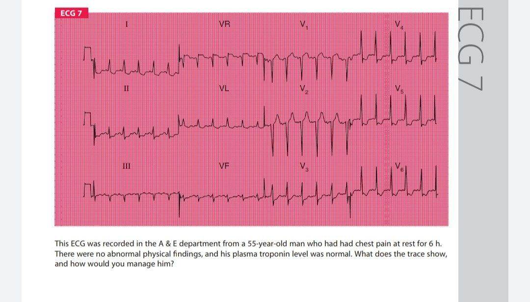 Solved ECG 7 VR ECG Z VL Pelabuhanbat June while LL VF V. | Chegg.com
