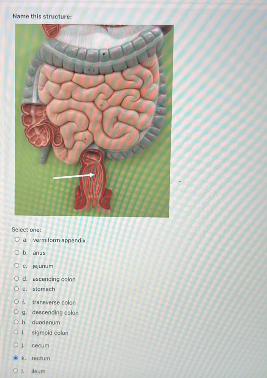 Solved Name this structure: Select one: O a. vermiform | Chegg.com