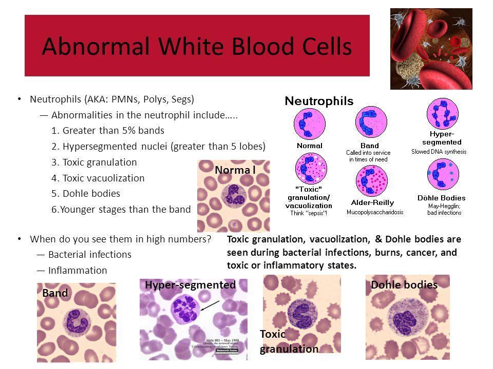 Toxic Granulation Vs Basophil