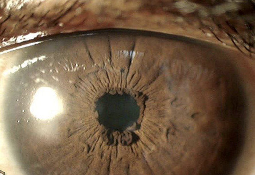 Iris Mammillations