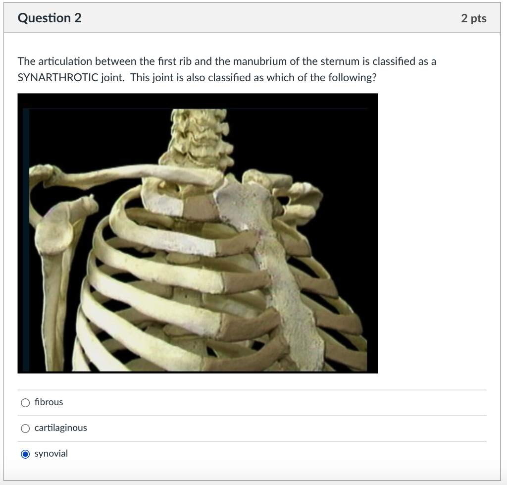 Solved Question 1 2 pts This form of curvature (lordosis) | Chegg.com
