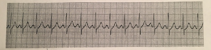 Solved Interpret the following ecg, 6 second strip: | Chegg.com