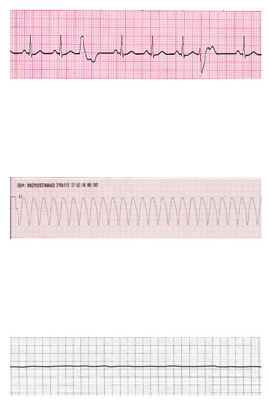 Solved For each of these rhythms: Name the rhythm, Describe | Chegg.com