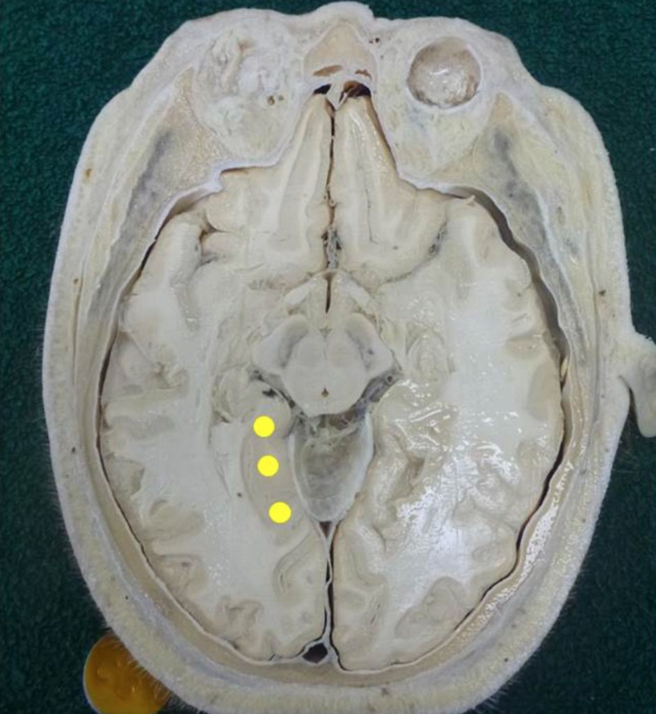 Solved Name the gyrus indicated by the yellow dots in this | Chegg.com