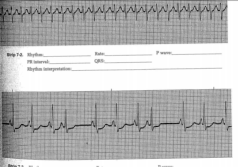 Solved Atrial Rhythm Packet 7.2 strip Rhythm: (regular or | Chegg.com