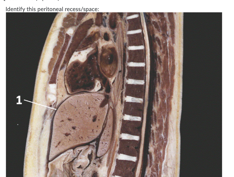 Solved Identify this peritoneal recess/space: 1 | Chegg.com