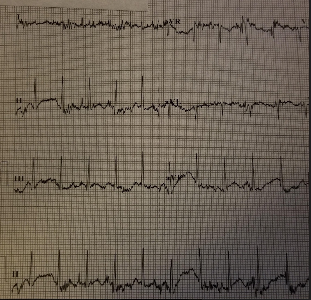Solved Given Lead I-III, AVR, AVL, AVF, V1-V6 Rhythm | Chegg.com