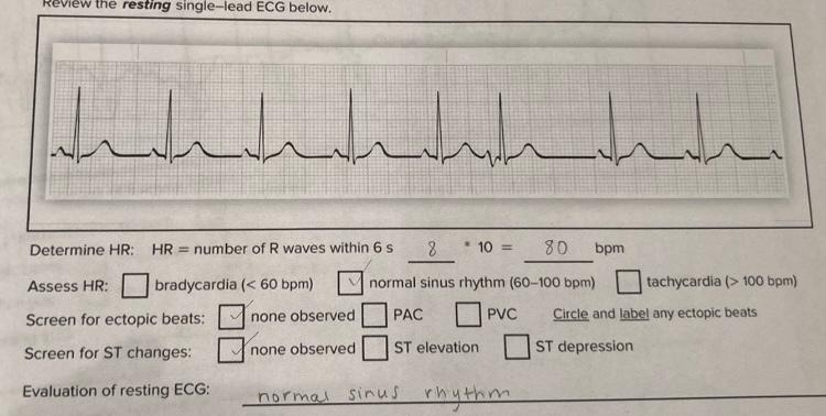 Solved Review the exercise single-lead ECG below. | Chegg.com