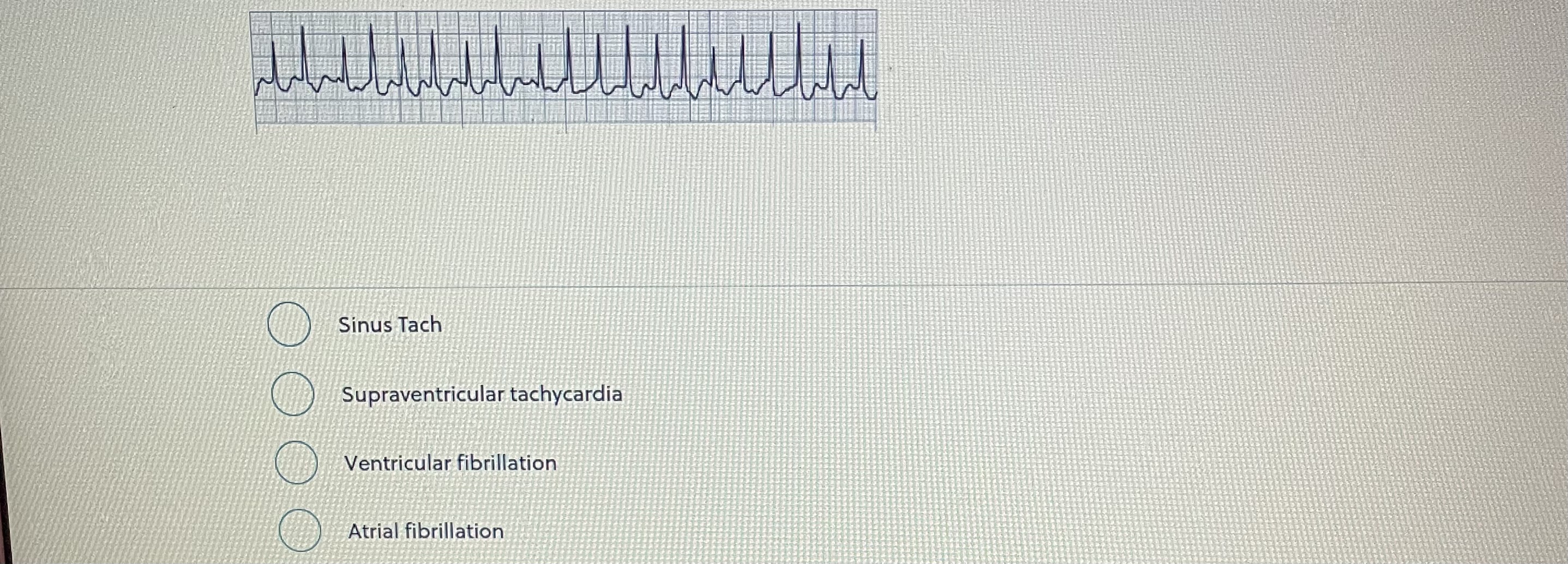 Solved Sinus Tach Supraventricular tachycardia Ventricular | Chegg.com
