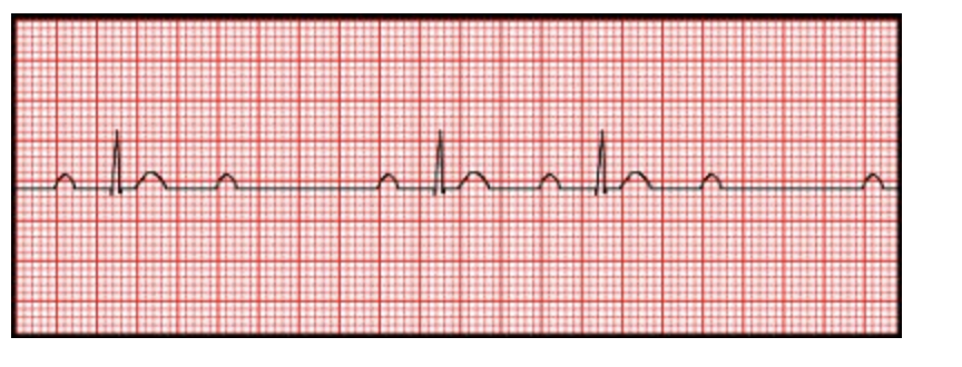 Solved Identify the EKG abnormality? Use the 300 rule to | Chegg.com