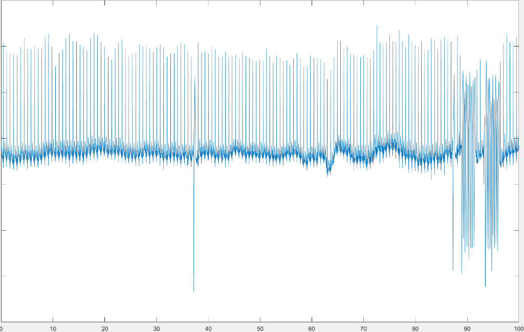 Find abnormalities in the following ECGs. In the | Chegg.com