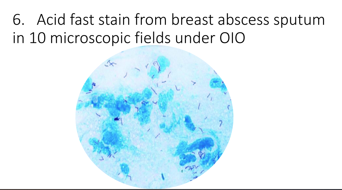 Solved 6. Acid fast stain from breast abscess sputum in 10 | Chegg.com