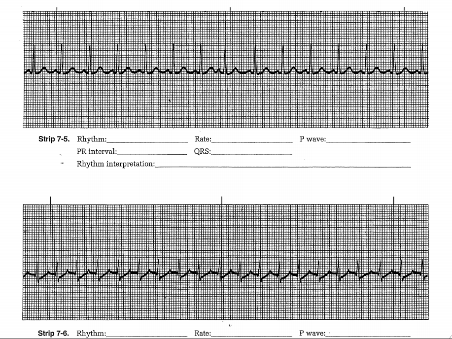 Solved Atrial Rhythm Packet 7.5 Rhythm: (regular or | Chegg.com