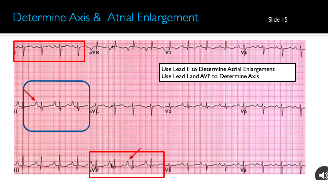 Solved Determine Axis & Atrial Enlargement Slide 14 A VA MI | Chegg.com