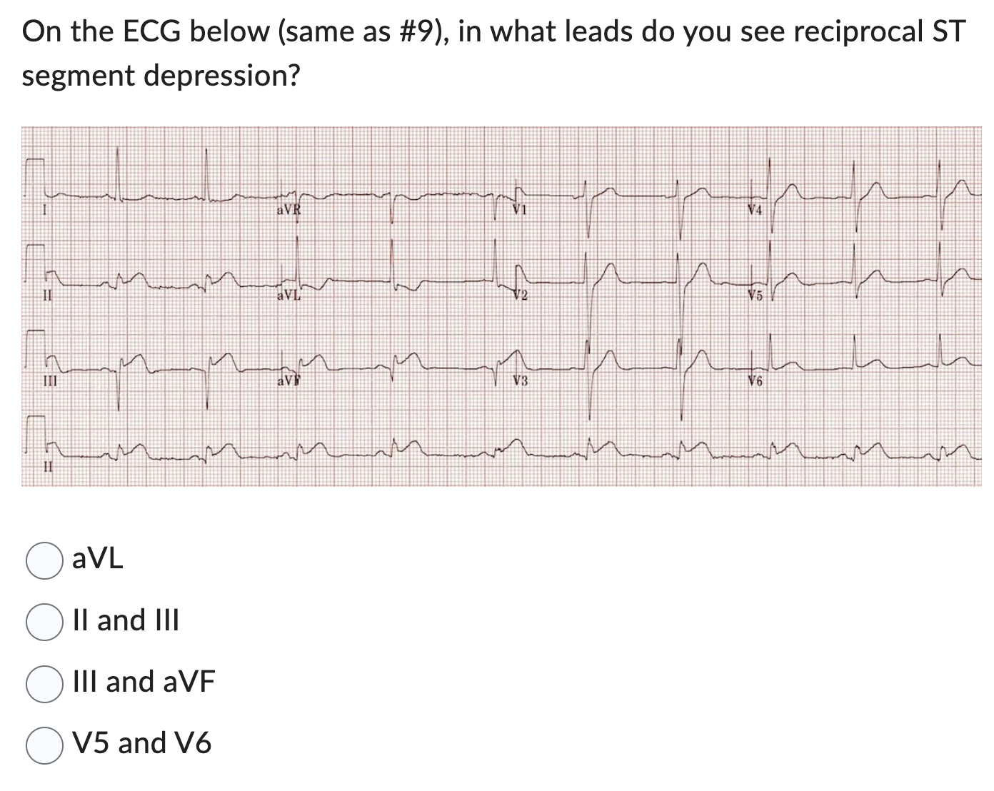 Solved On this ECG below, what leads show ST segment | Chegg.com