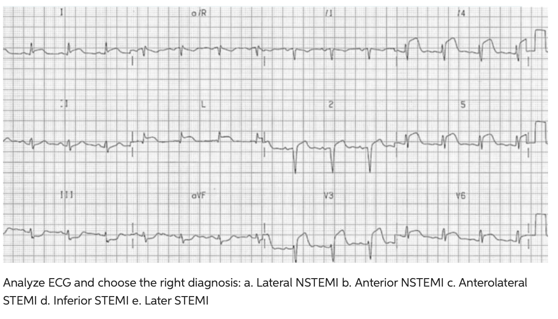 Solved Analyze ECG and choose the right diagnosis: a. | Chegg.com