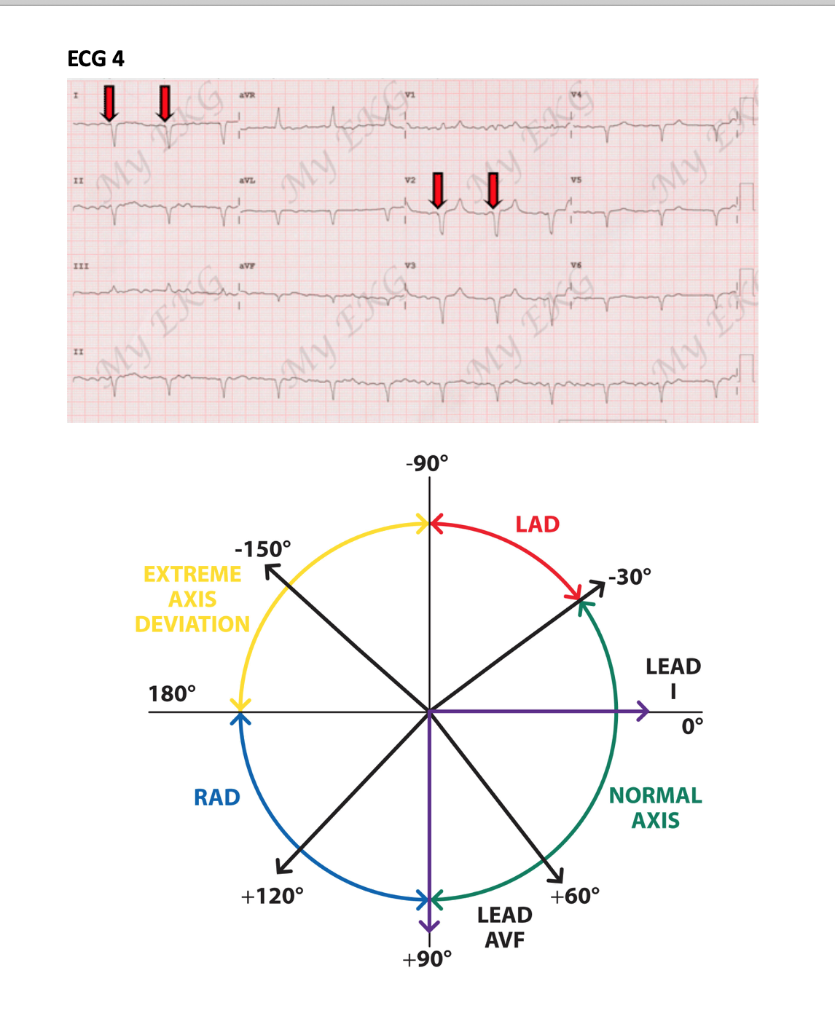 Solved ECG 4 1 V II VS MY MY ΣΙΣ Chythm TI my Esco -90° LAD | Chegg.com