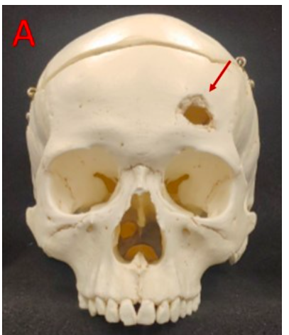 Solved Examine the images below. On what bones are trauma A | Chegg.com