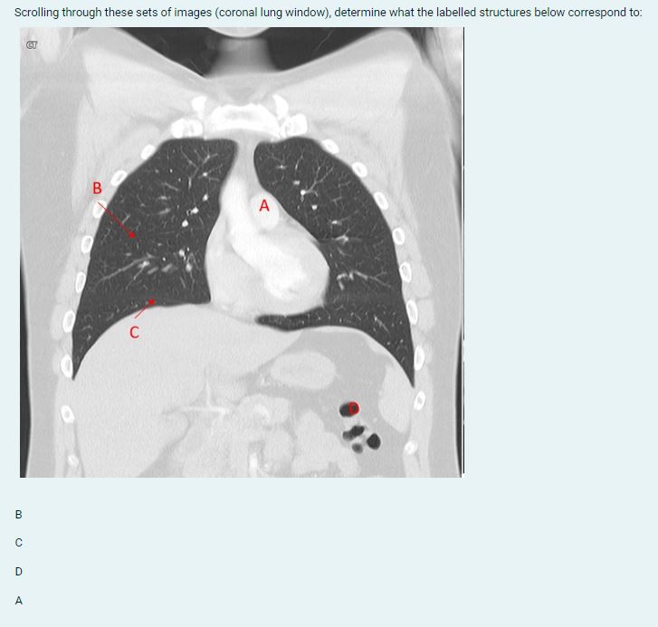 Solved Scrolling through these sets of images (coronal lung | Chegg.com