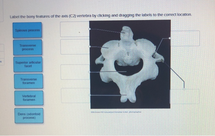 Solved Labels the bony features of the axis (C2) vertebra by | Chegg.com