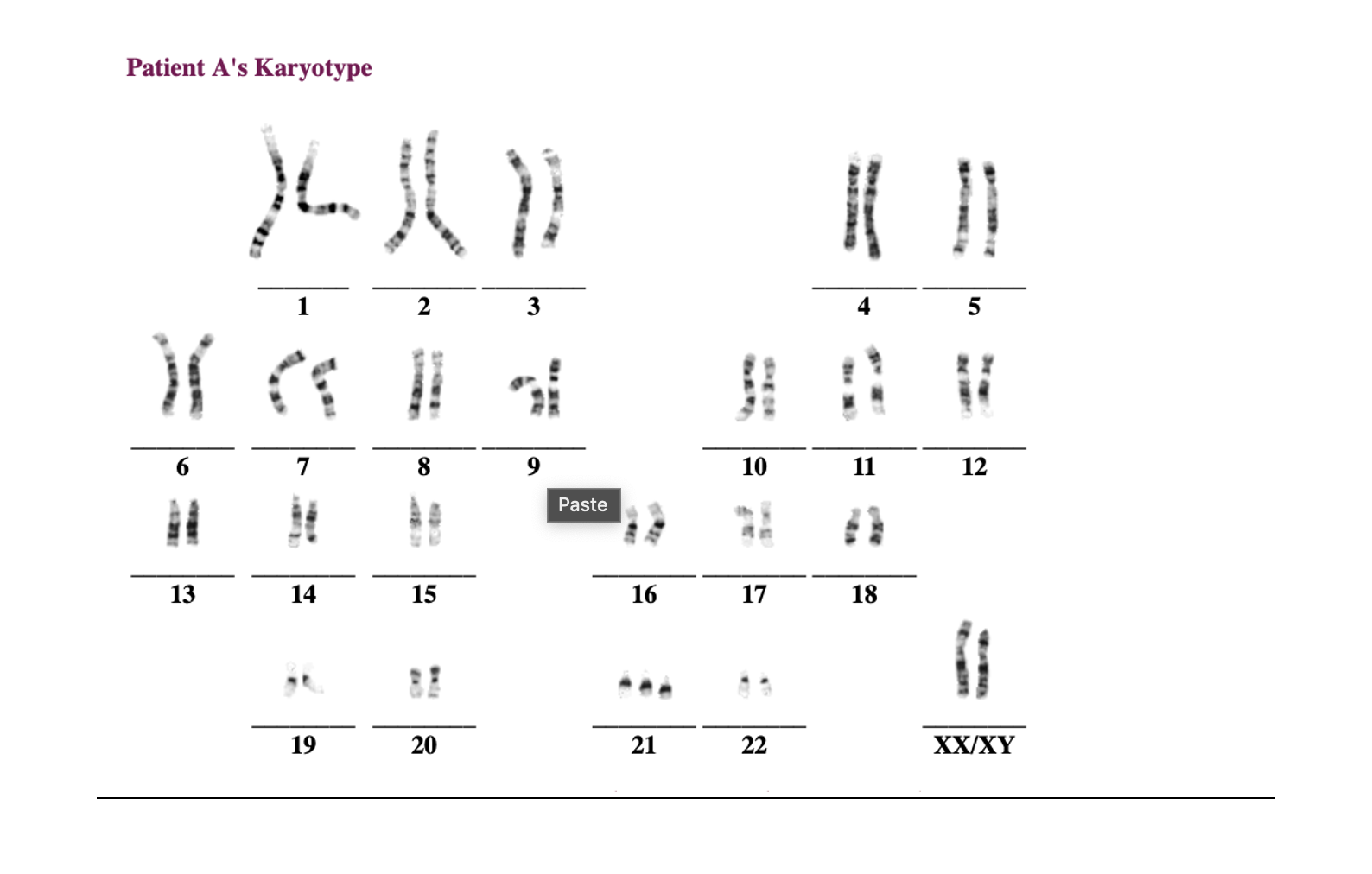 Solved Diagnosis of patients with abnormal chromosomes: | Chegg.com