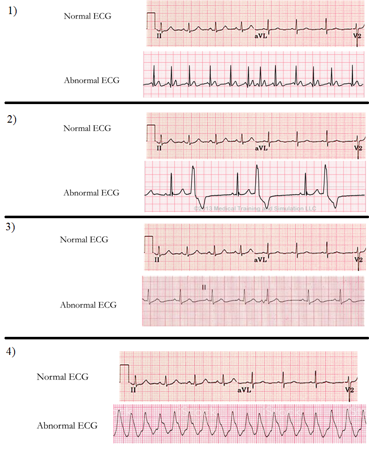 Normal Vs Abnormal Ecg