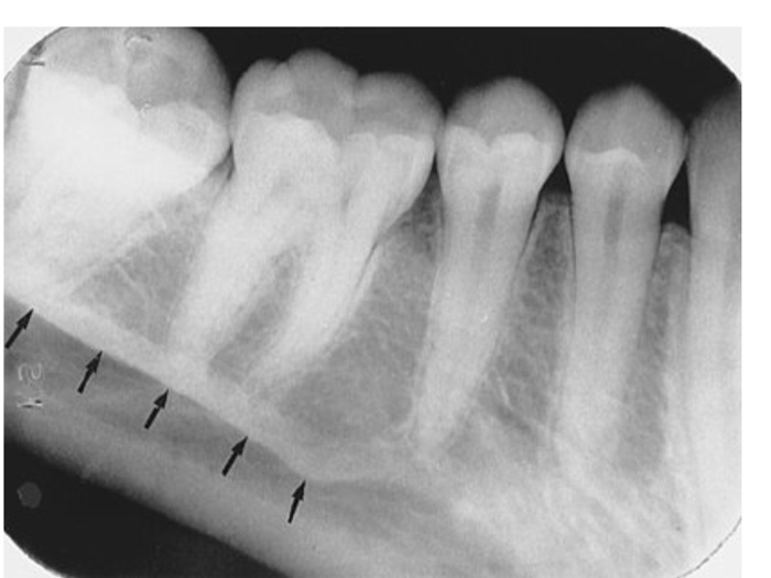 Mylohyoid Ridge Radiograph