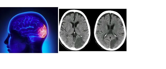 Solved Damage to specific regions of the cerebral | Chegg.com