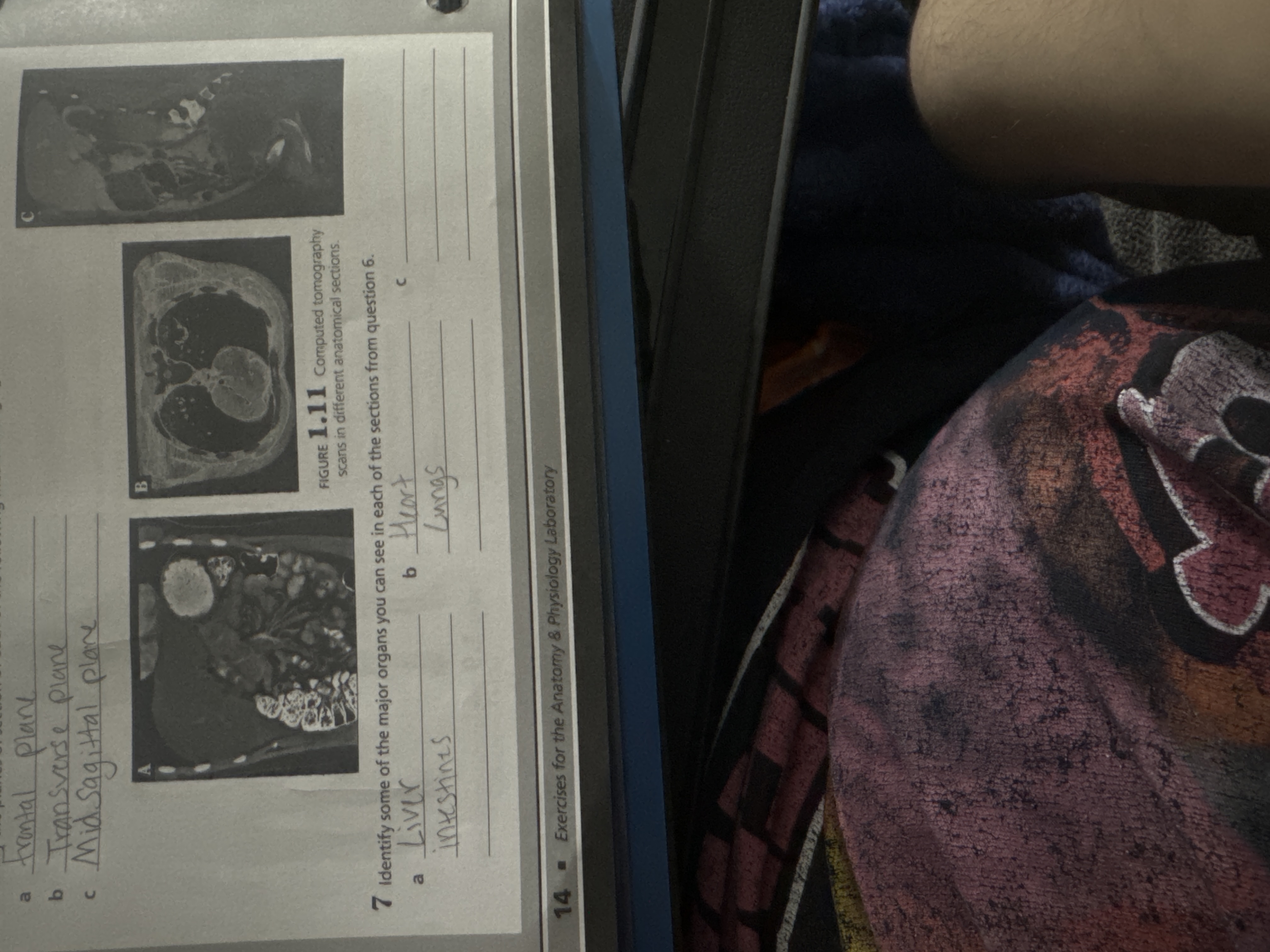 [Solved]: C FIGURE 1.11 Computed tomography scans in differ