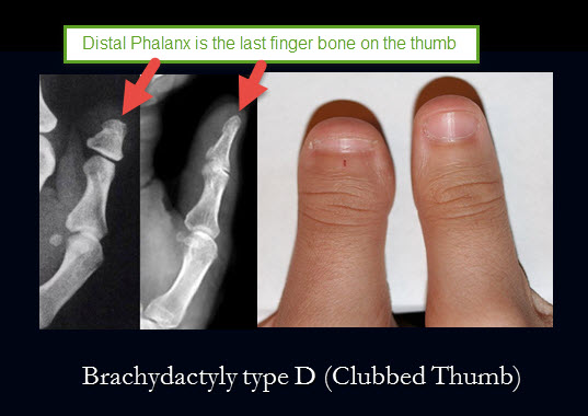 Solved The images above shows an individual with a common | Chegg.com
