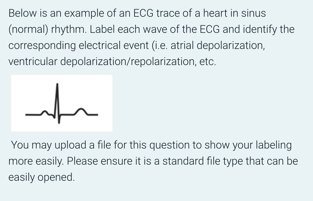 Solved Below is an example of an ECG trace of a heart in | Chegg.com