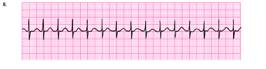 Solved Label the arrhythmia type on the EKG strip: (No | Chegg.com