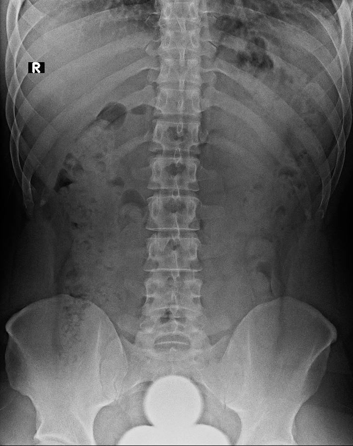 Solved 1. Locate the left L2 transverse process. Locate | Chegg.com