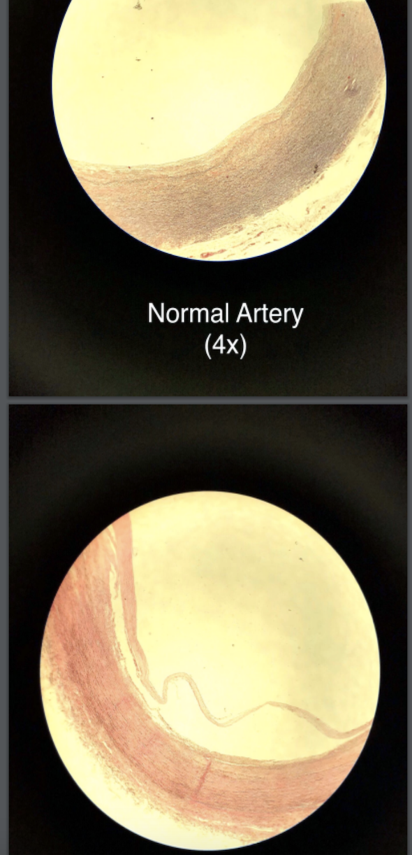 Solved 1. Normal Artery (top image): Draw this under low | Chegg.com
