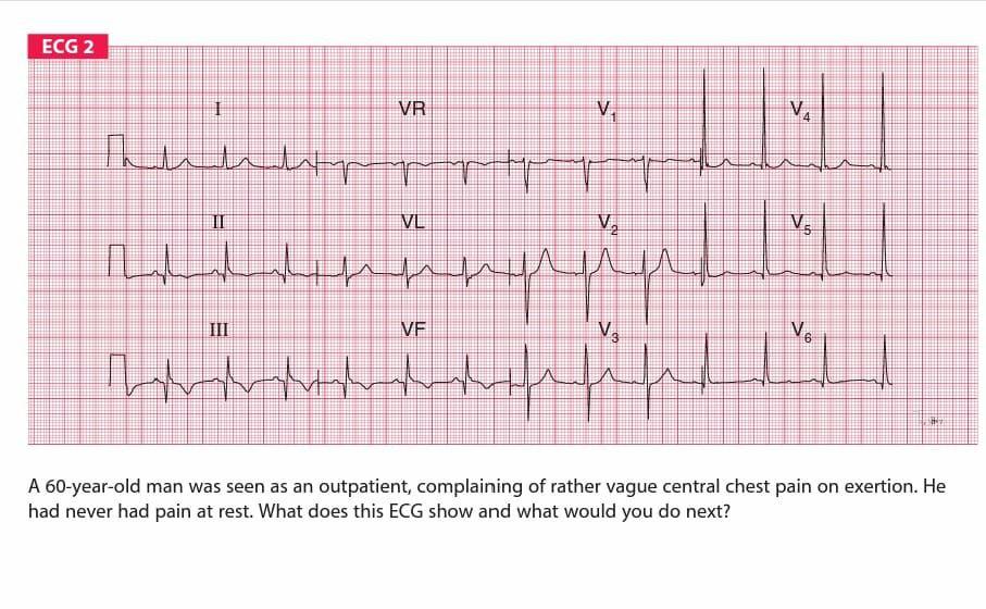 Solved ECG 2 1 VR V VA Tuun اسم استعمال th II VL V2 VE 5 | Chegg.com
