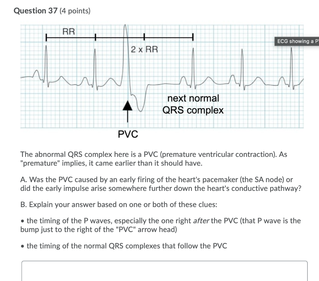 Solved Question 37 (4 points) RR + + 2 x RR ECG showing a P | Chegg.com