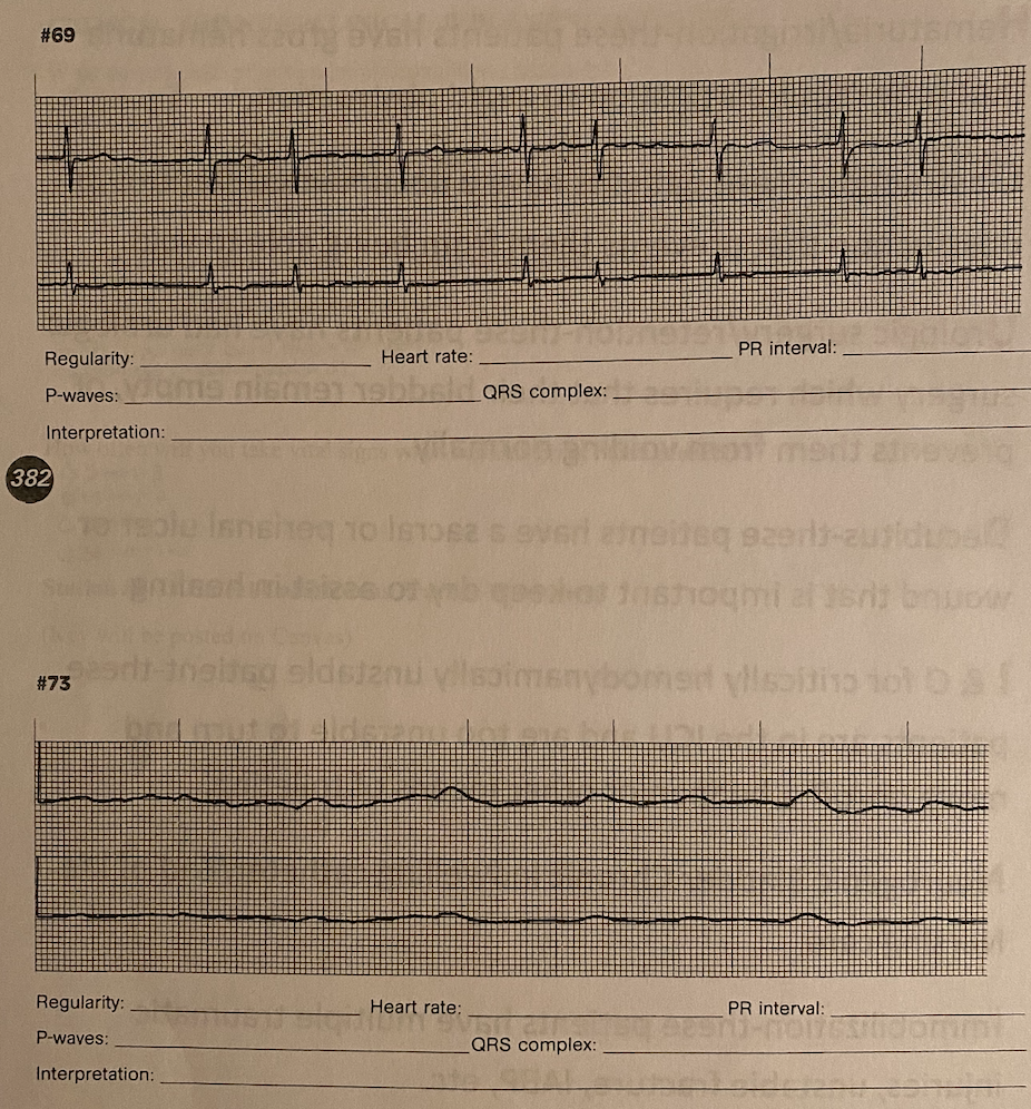 Solved Regularity: Heart rate: PR interval: P-waves: QRS | Chegg.com