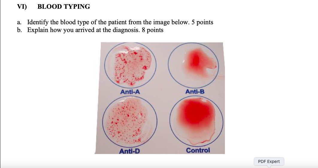Solved VI) BLOOD TYPING a. Identify the blood type of the | Chegg.com