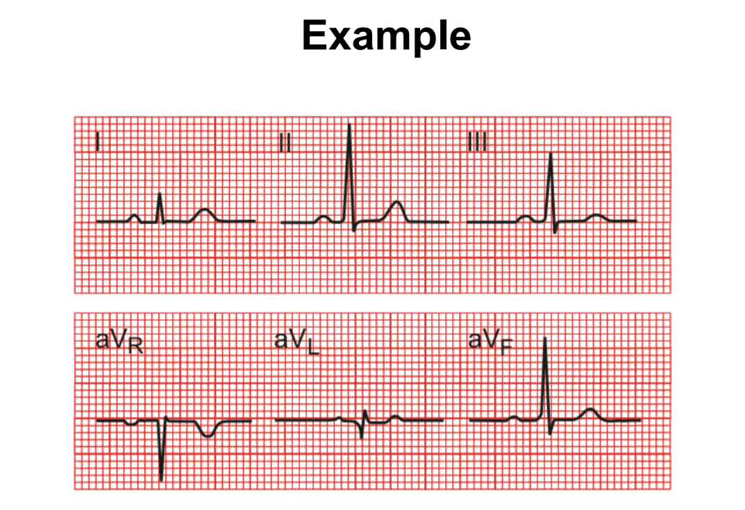 Solved Quadrant approach Lead aVF positive negative positive | Chegg.com