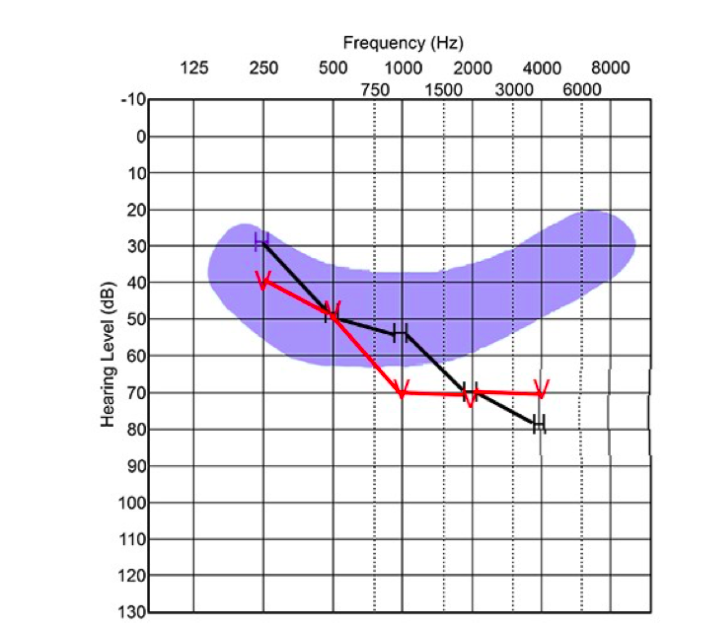 Solved What type of hearing loss does this audiogram show? | Chegg.com